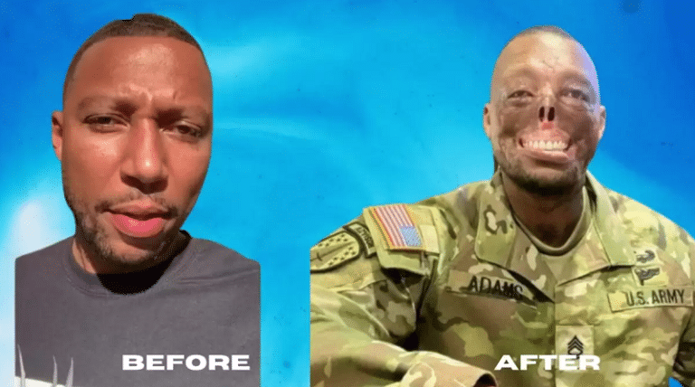 What Happened to Randy Adams Face? Randy Adams Face Burn Before and ...